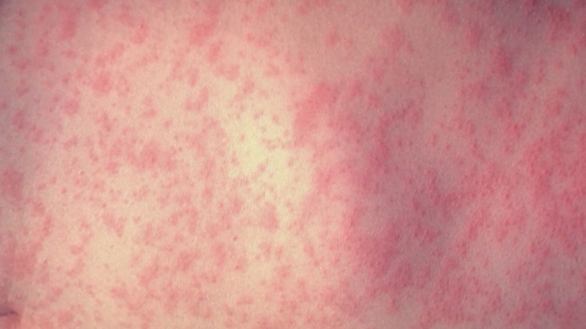 Measles outbreak in Texas: Latest updates, data and cases | wfaa.com