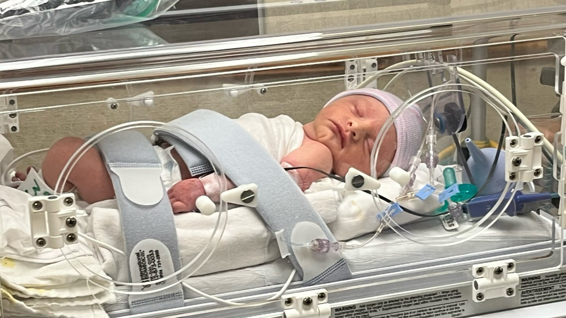 Doctors get creative to help baby born with dent in skull | wfaa.com