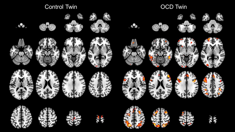 MRIs can help us accept mental illness | wfaa.com