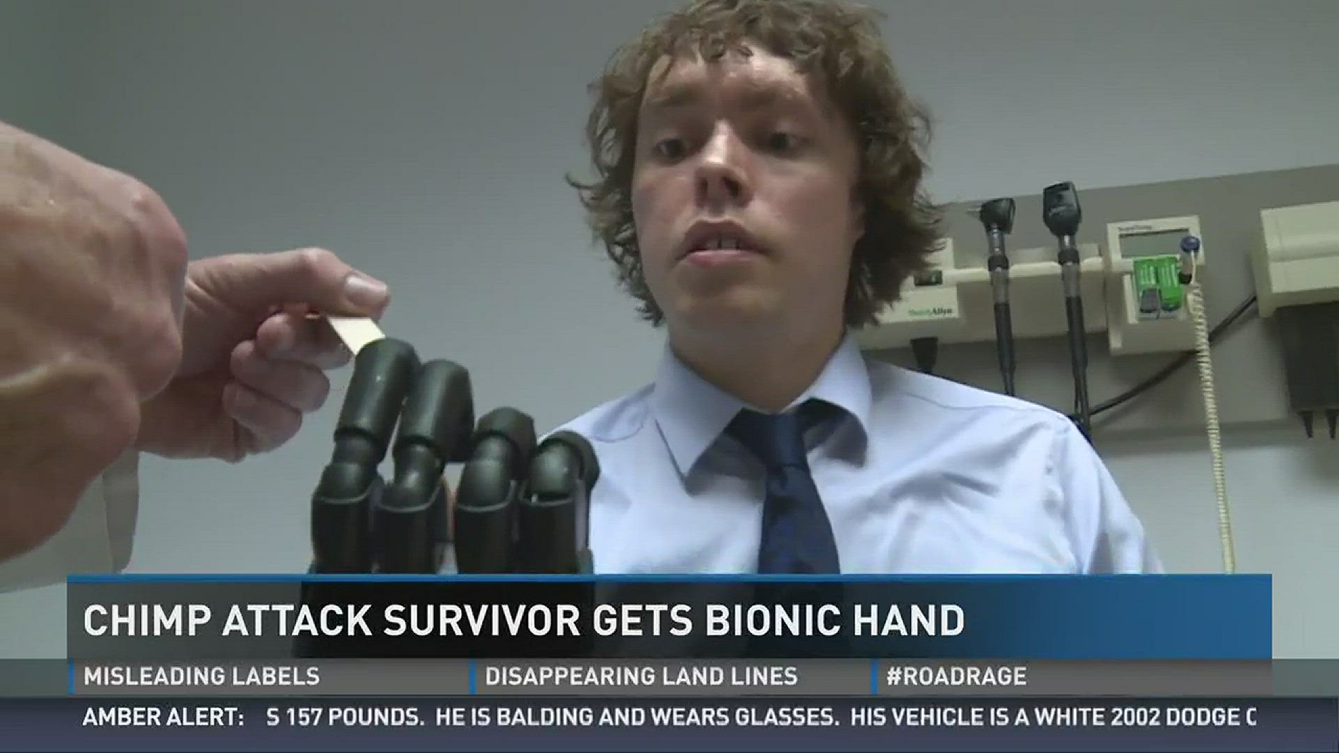 Man attacked by chimps gets bionic hand | wfaa.com