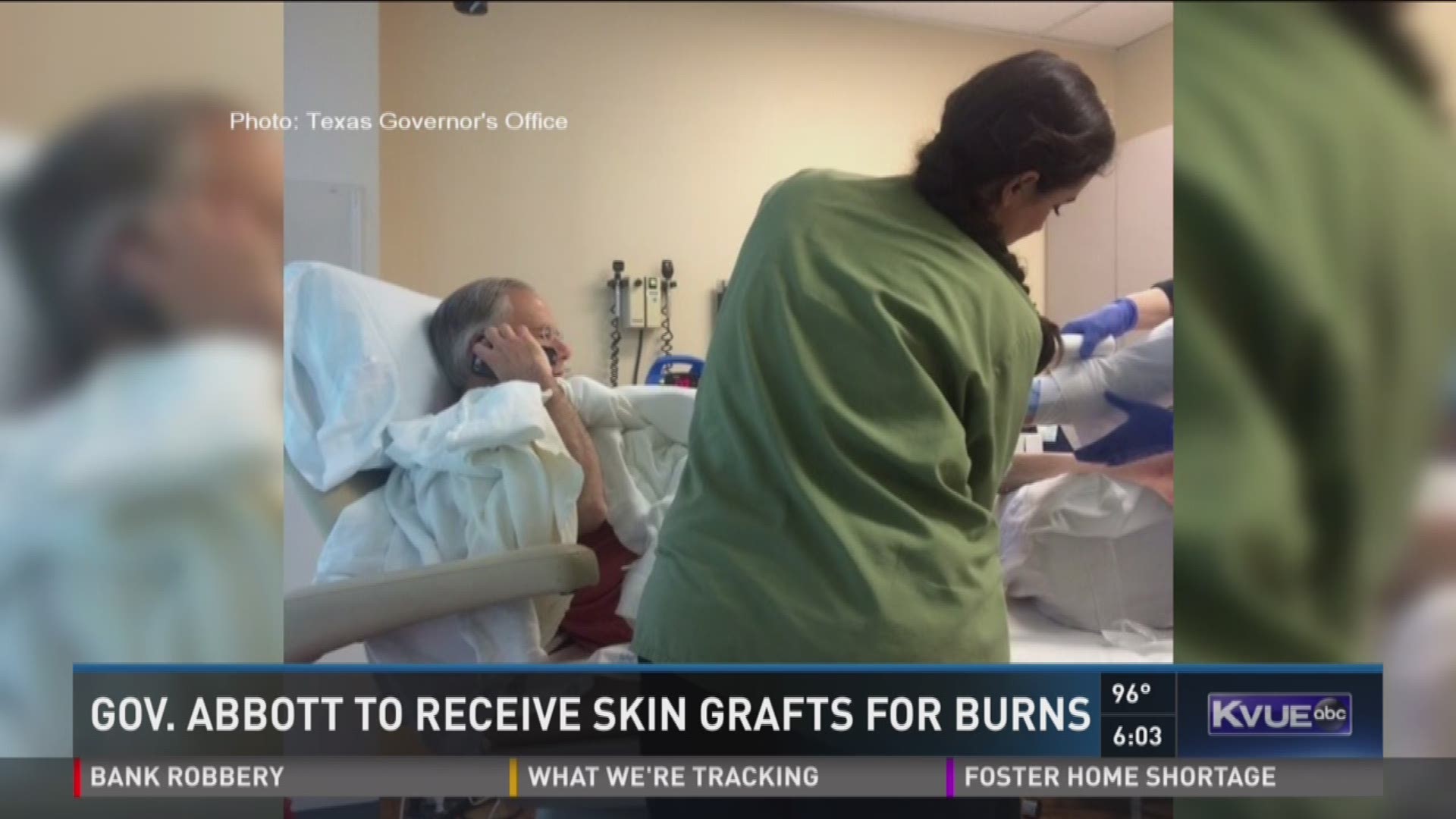 Gov. Abbott receives skin grafts for burns, extends hospital stay ...
