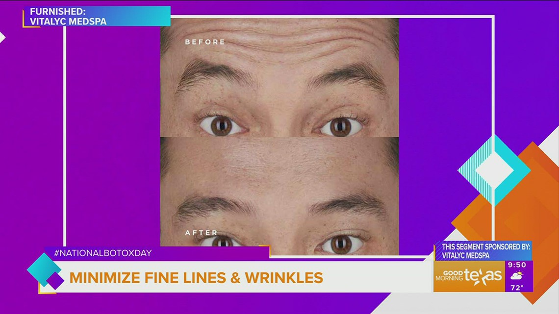 Minimize fine lines & wrinkles this National Botox Day | wfaa.com