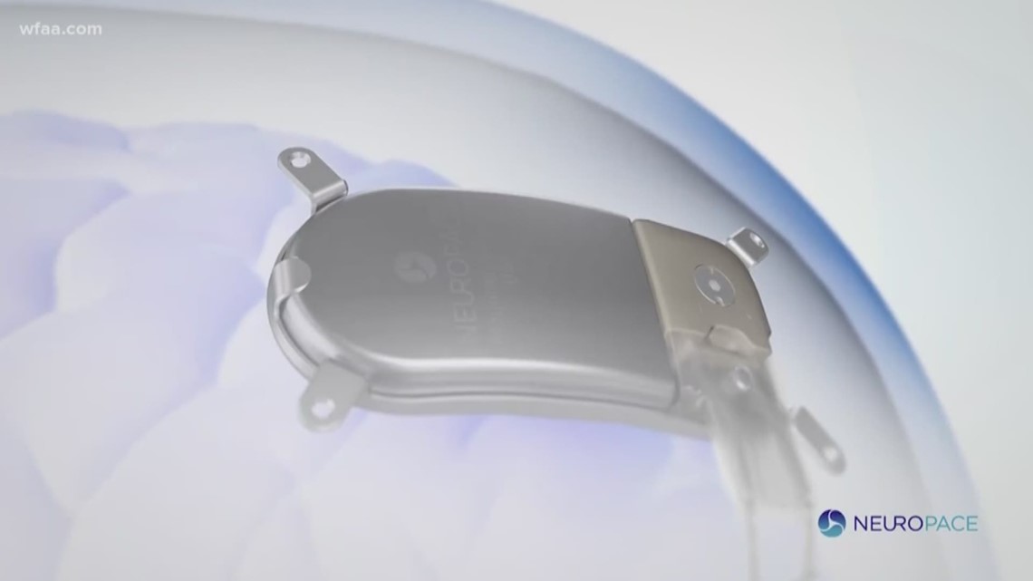 NeuroPace RNS: A breakthrough surgery in curbing epilepsy that can be ...