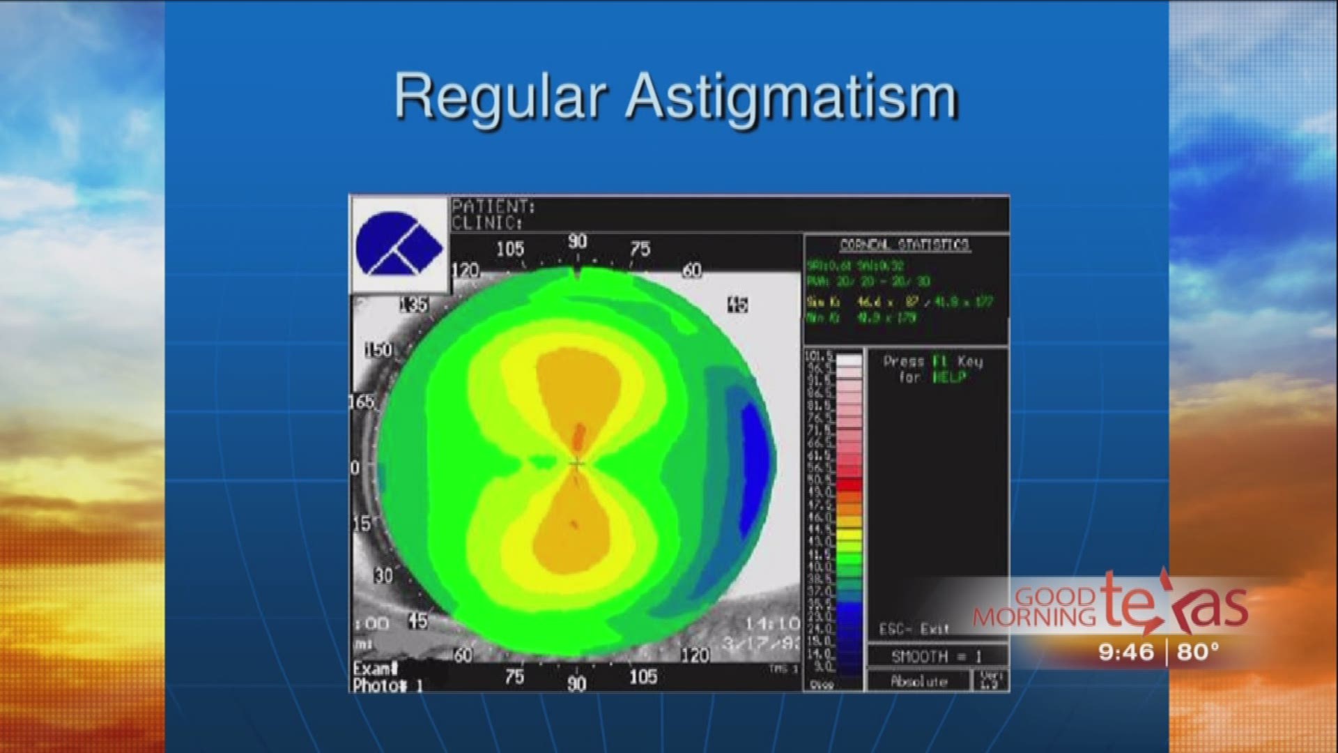 What is Astigmatism? | wfaa.com