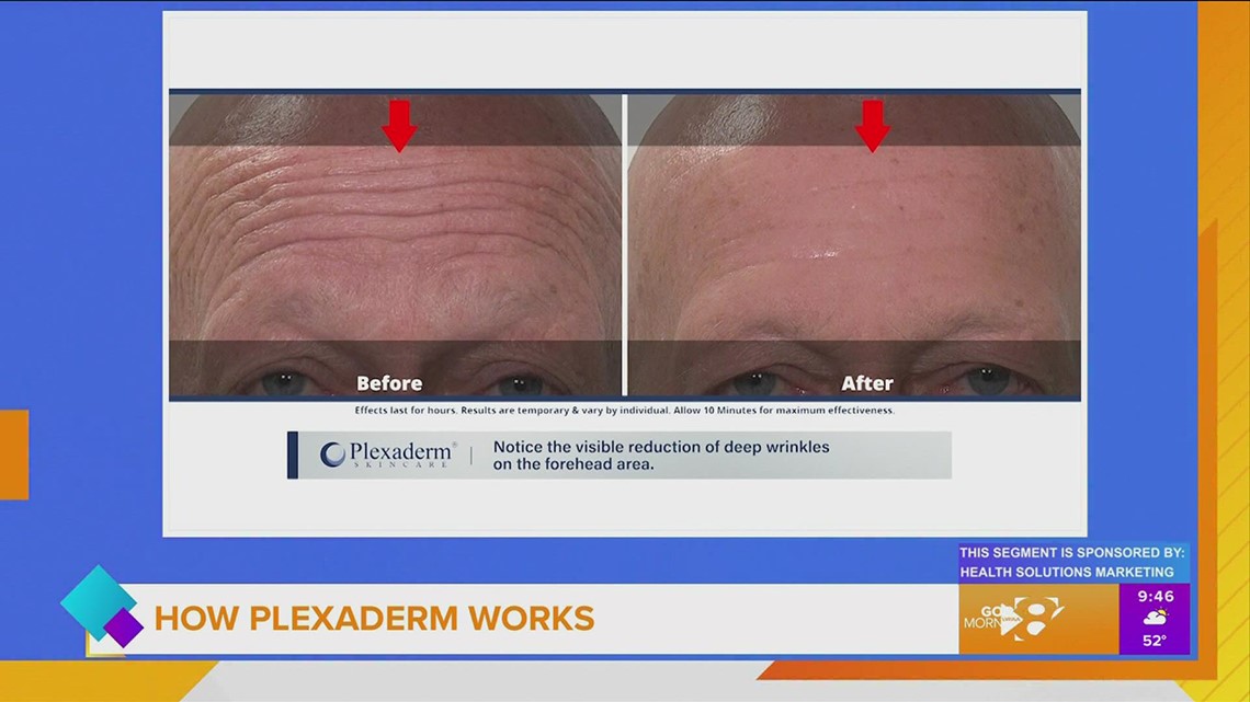 How Plexaderm works | wfaa.com
