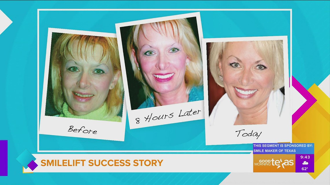 Smile lift procedure | wfaa.com