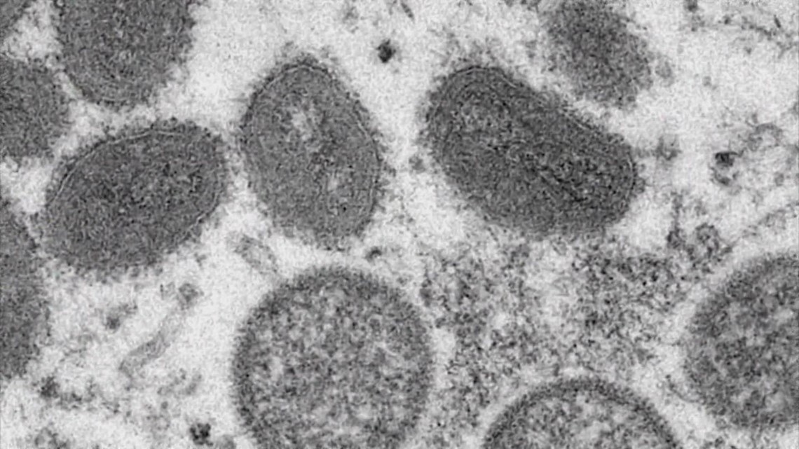 Monkeypox updates in Dallas: County declares emergency | wfaa.com