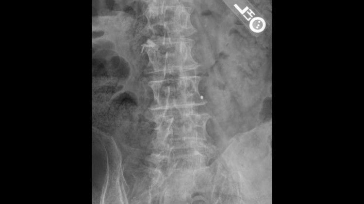 Grenade shrapnel removed from Vietnam veteran after 51 years | wfaa.com