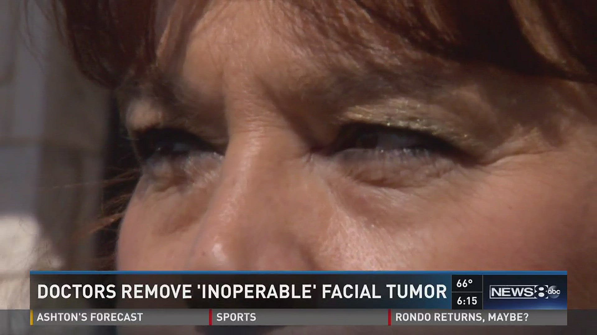 Local doctors remove 'inoperable' facial tumor | wfaa.com