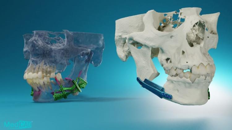 MedCAD unveils 3D-printed surgical devices for facial reconstruction ...