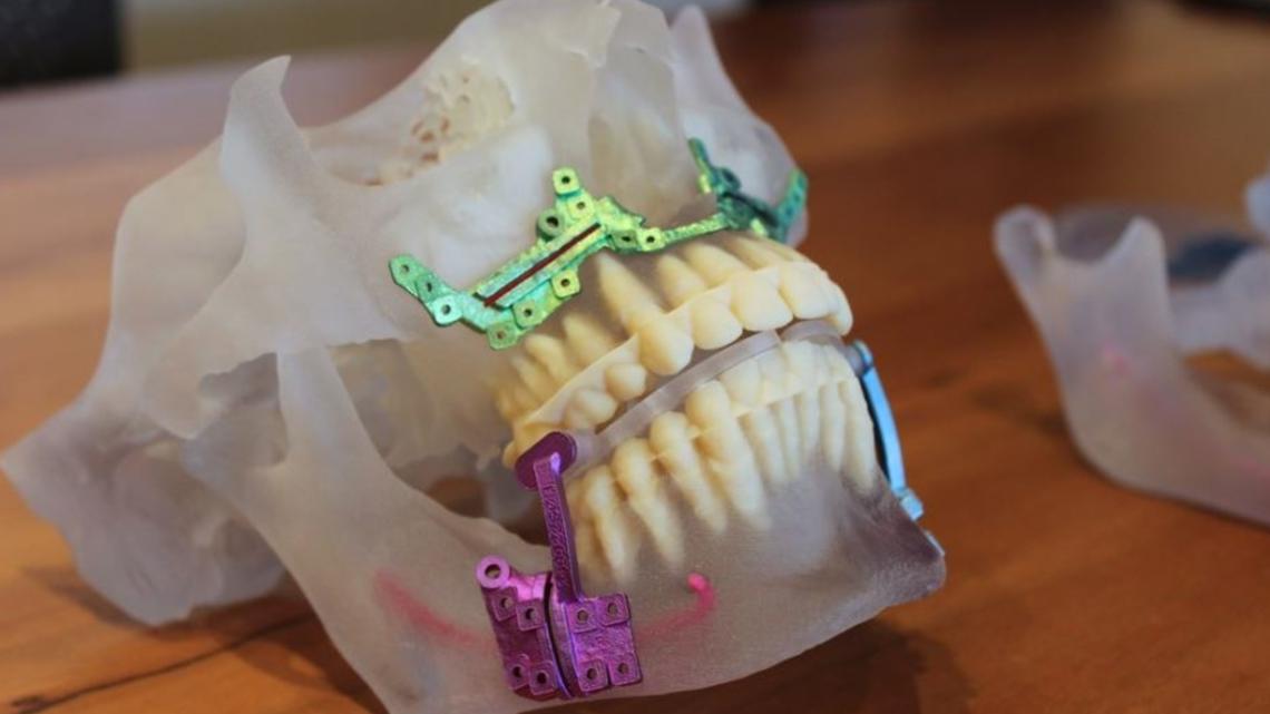 MedCAD unveils 3D-printed surgical devices for facial reconstruction ...