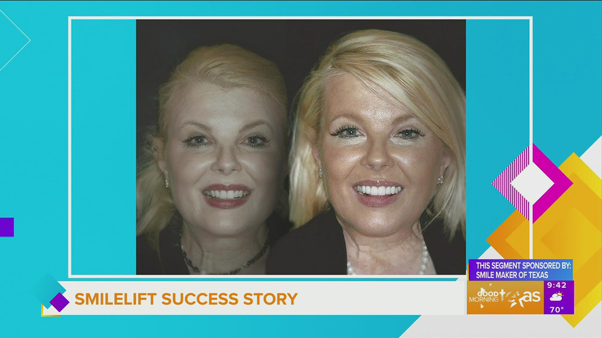 SmileLift Success Story | wfaa.com
