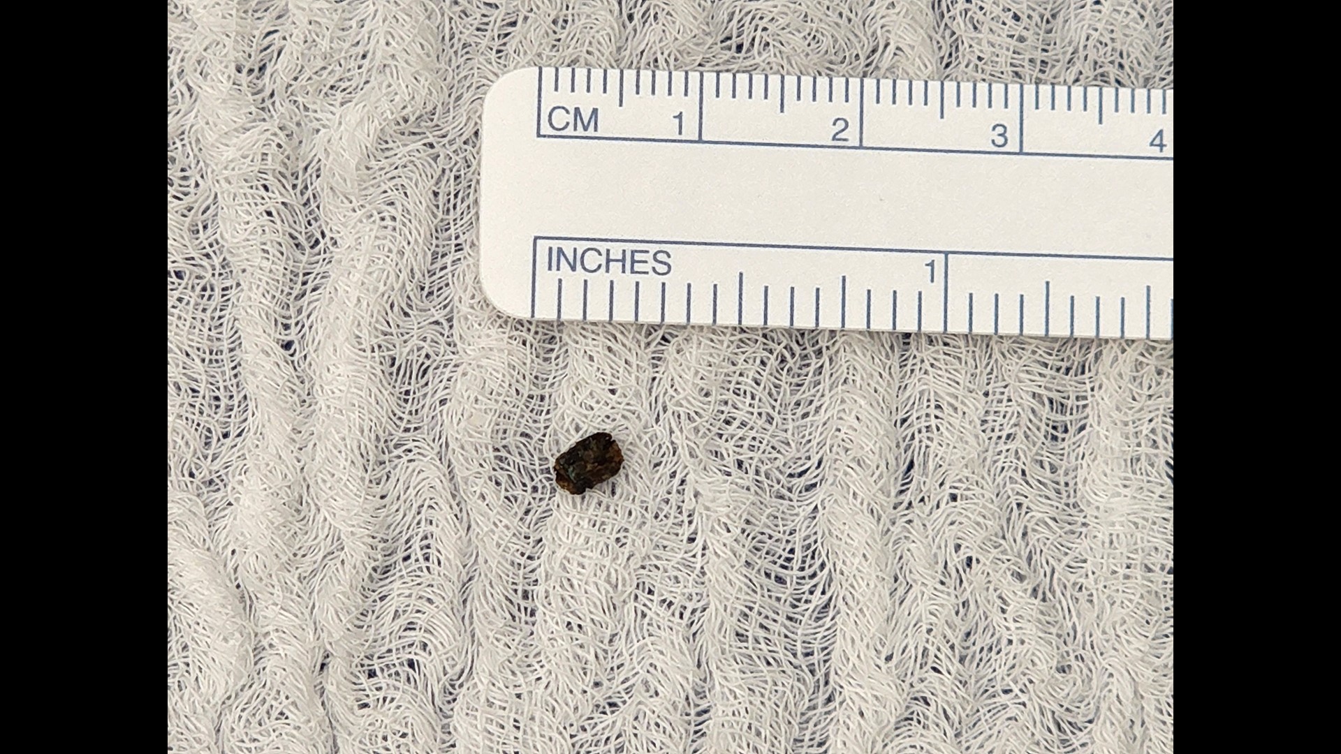 Grenade shrapnel removed from Vietnam veteran after 51 years | wfaa.com