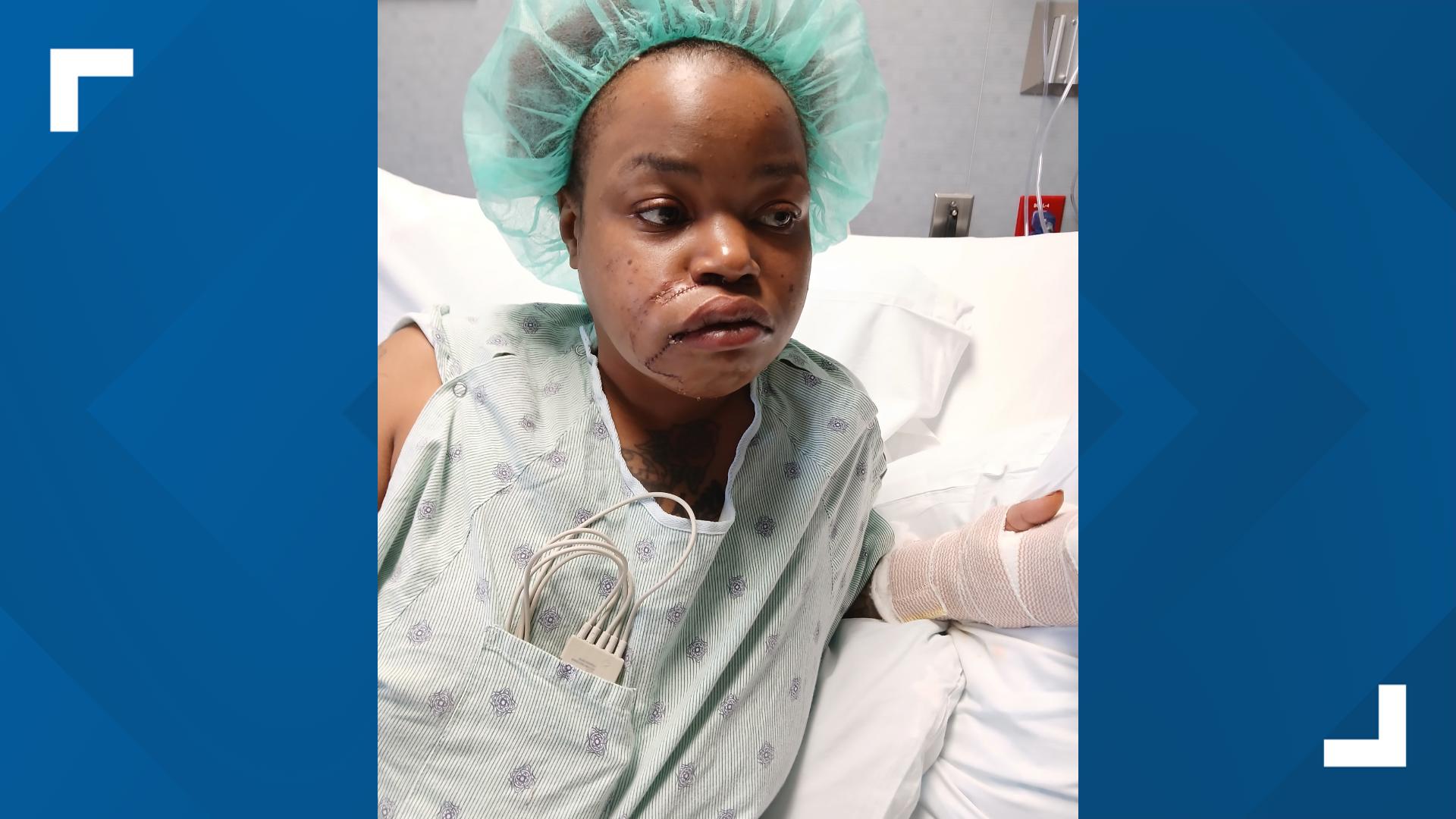 'It snapped my finger in half' | Oak Cliff woman describes brutal dog ...