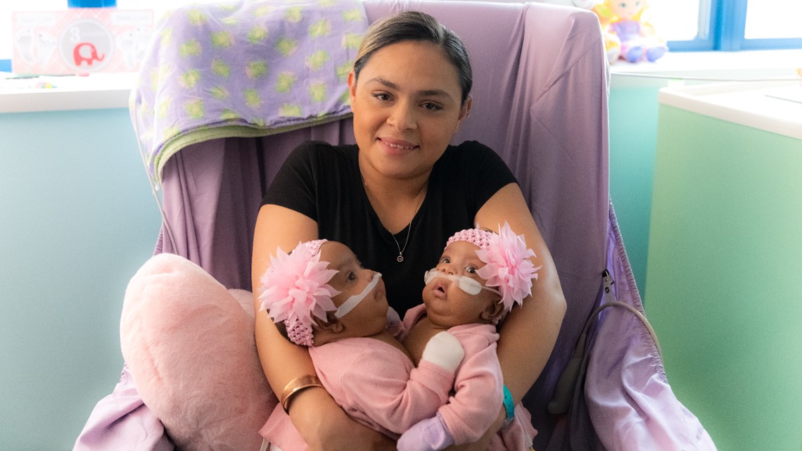 Formerly conjoined twins celebrate one year post-op | wfaa.com