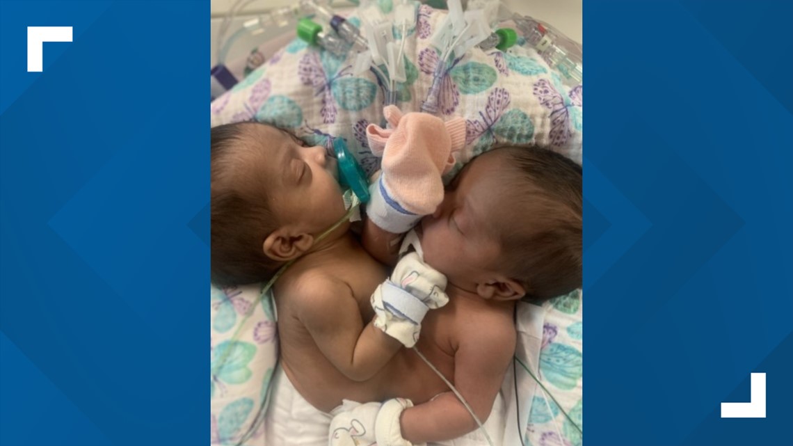 Fort Worth: Cook Children's conjoined twins separated | wfaa.com