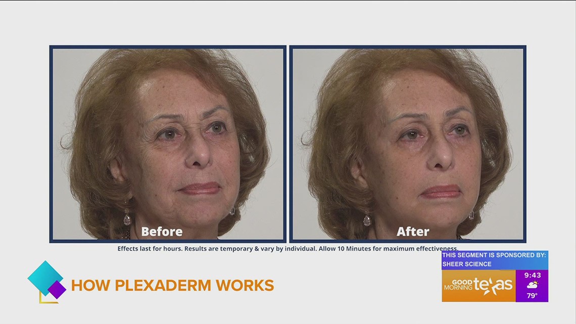 How Plexaderm works | wfaa.com