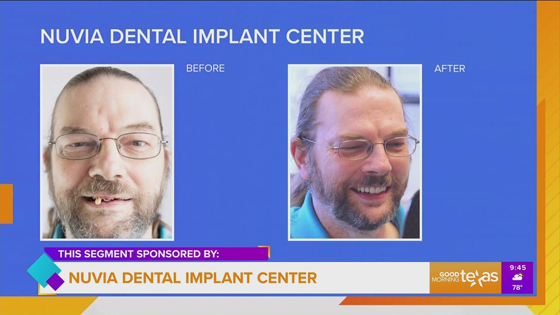 Nuvia Dental Implant Center's 24 hour permanent teeth | wfaa.com