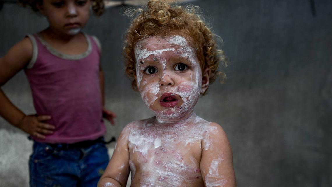 Skin disease runs rampant in Gaza tent camps | wfaa.com