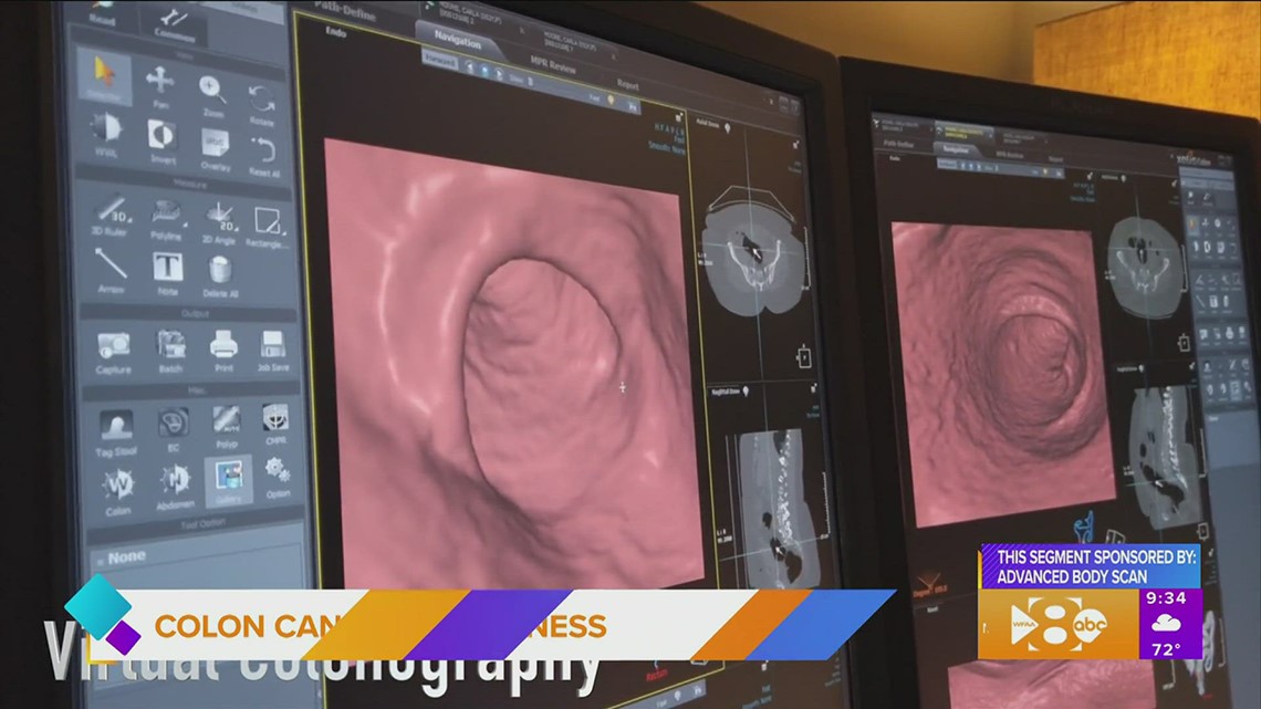 Colon Cancer Awareness with Advanced Body Scan | wfaa.com