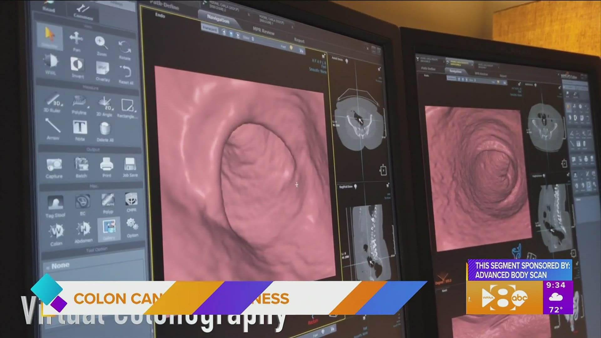 Colon Cancer Awareness with Advanced Body Scan | wfaa.com