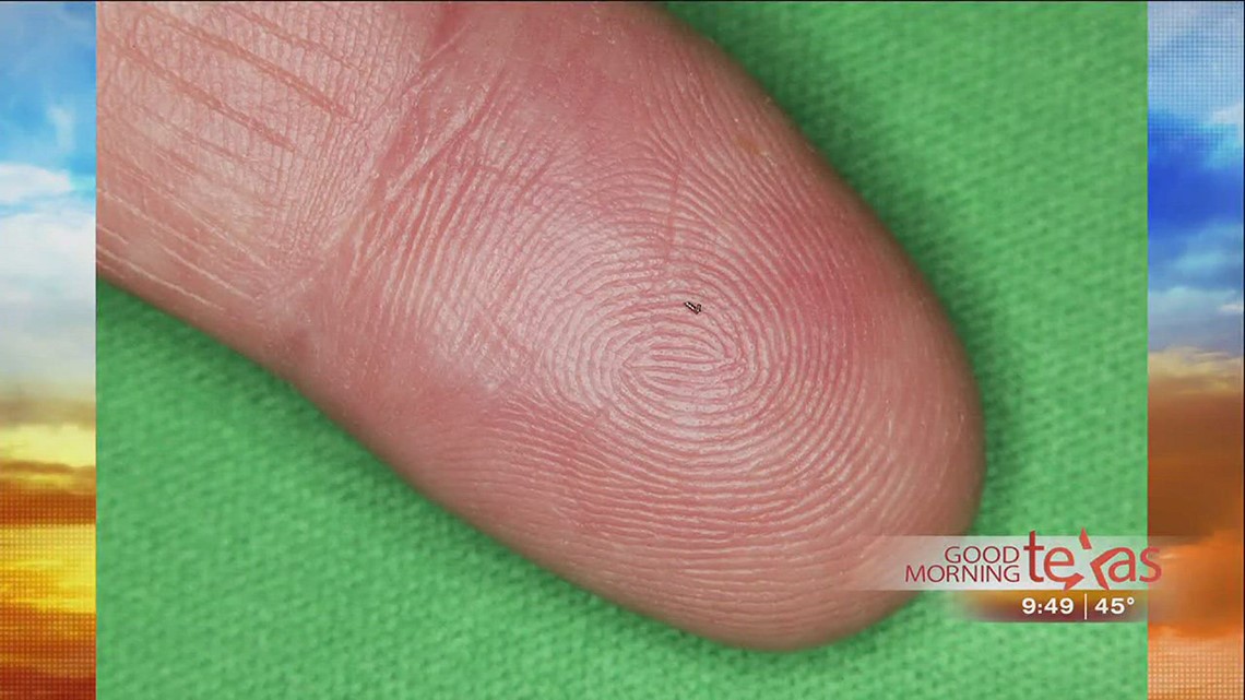 A surgical option to reduce eye pressure from glaucoma | wfaa.com