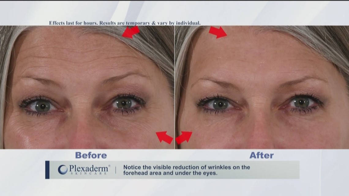 Plexaderm can help you look younger! | wfaa.com